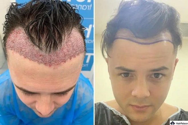 Greffe de Cheveux Ratée à l’Étranger : Dangers, Prix et Solutions de ...